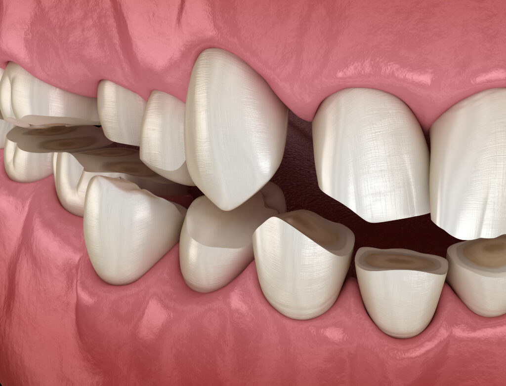 Procedures - Dentist Statesboro GA | Statesboro Family Dental